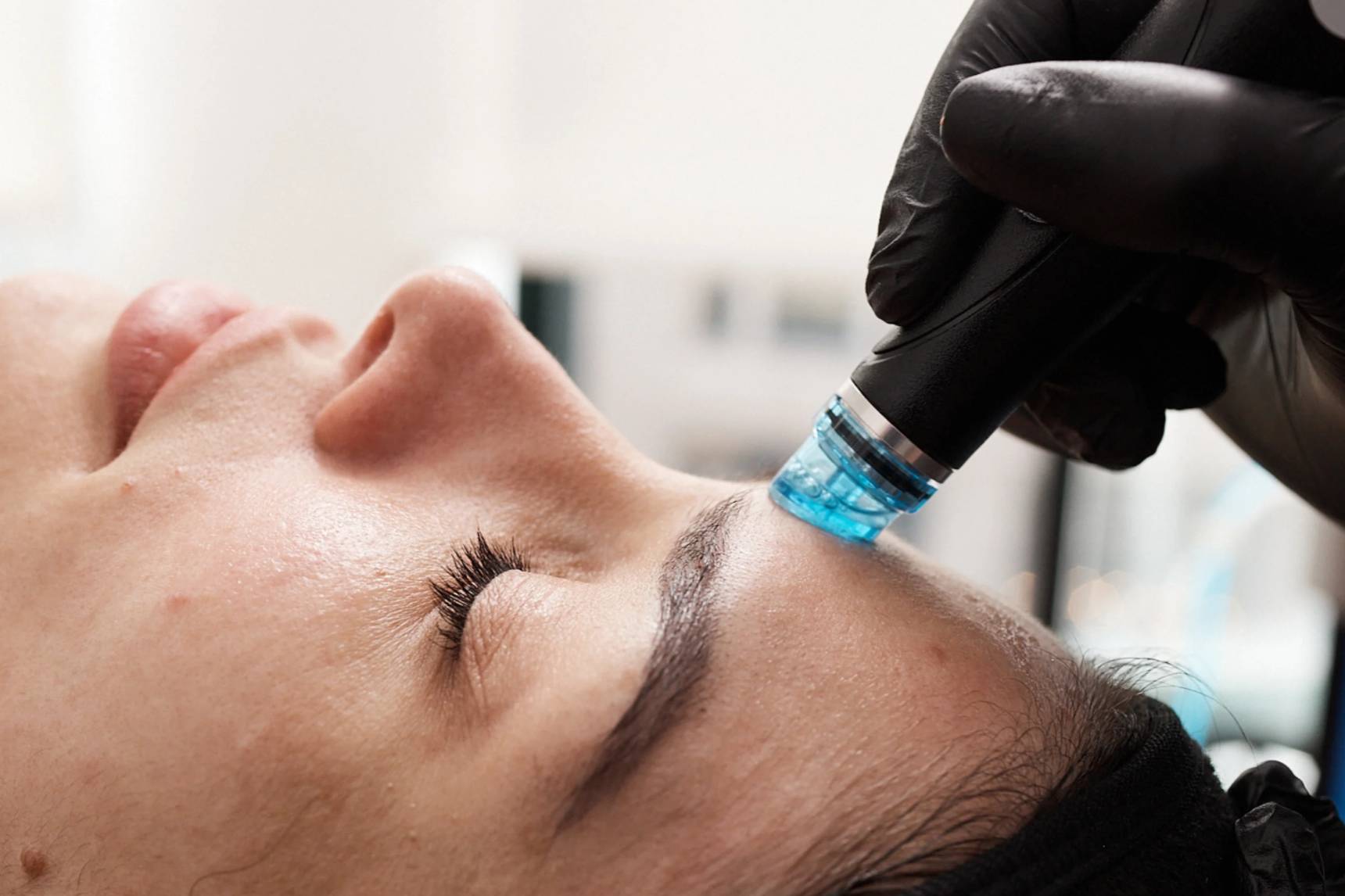 What Is the Best Facial for Acne? Why Hydrafacial Sets the Gold ...